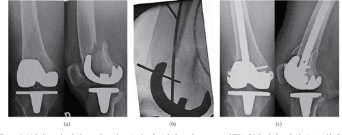 Figure 1 from Retrograde Intramedullary Nailing with a Blocking Pin ...