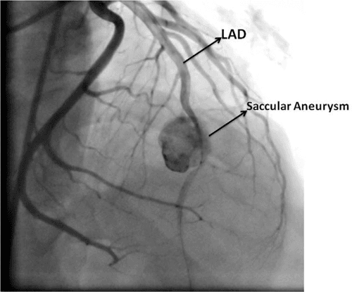 Successful treatment for a giant coronary saccular aneurysm complicated ...