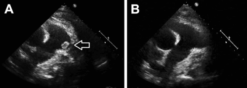 Figure 1 from Contralateral pulmonary embolism caused by pulmonary ...