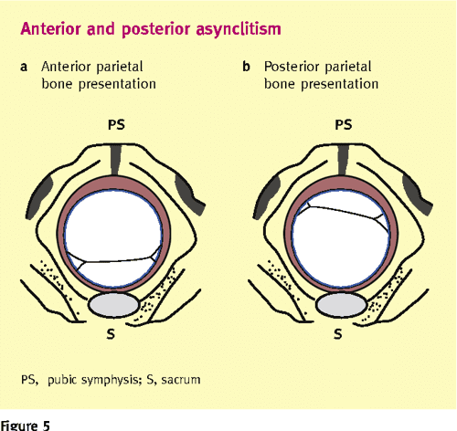 Figure 4 from Malpositions and malpresentations of the fetal head ...