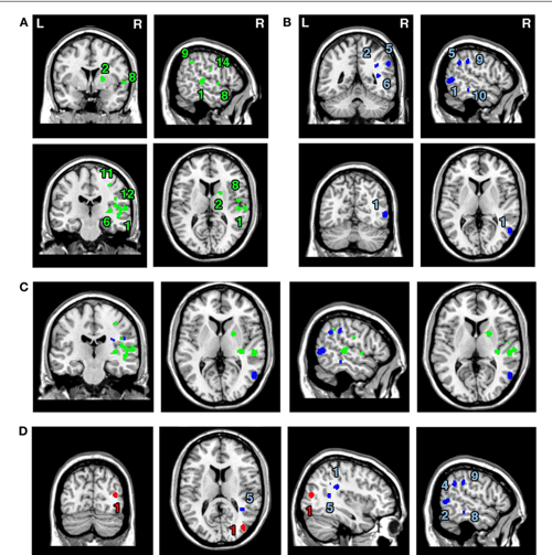 Figure 1 From Neuroanatomical Dissections Of Unilateral Visual Neglect Figure 1 From Neuroanatomical Dissections Of Unilateral Visual Neglect