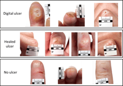 Figure 1 from A study examining the reliability of digital ulcer ...
