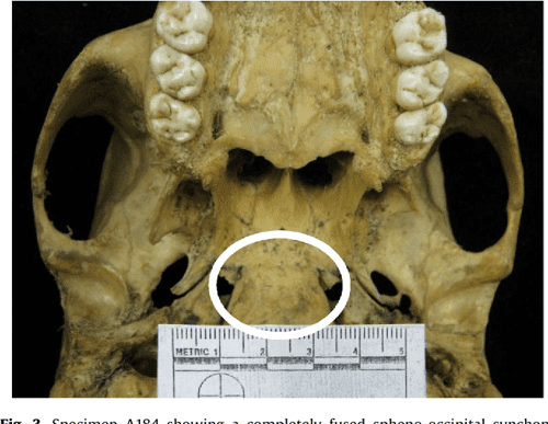 Spheno-occipital synchondrosis: Examining the degree of fusion in a ...