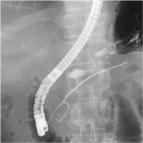 Figure 3 from A case of endoscopic minor duodenal papillectomy after ...