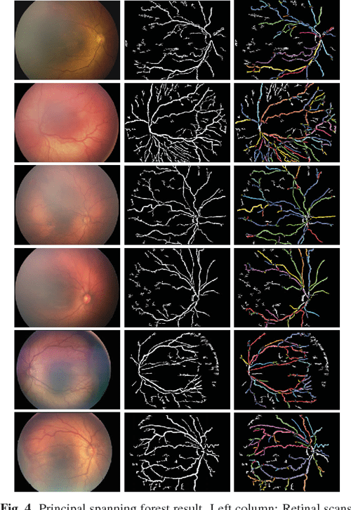 Figure 4 from Retinal vasculature segmentation using principal spanning ...