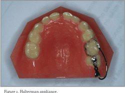 Figure 1 from Clinical tips for the Halterman appliance. | Semantic Scholar