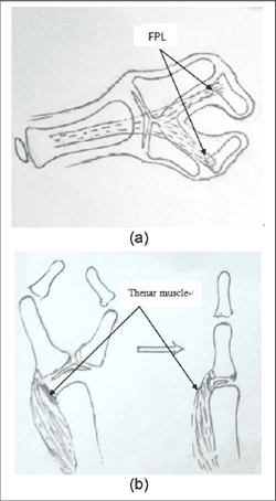 Table 1 from The anatomy of Wassel type IV-D thumb duplication ...