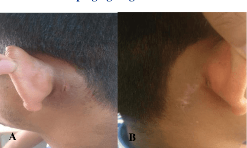 Figure 1 from Kimura’s disease as an uncommon cause of post auricular ...