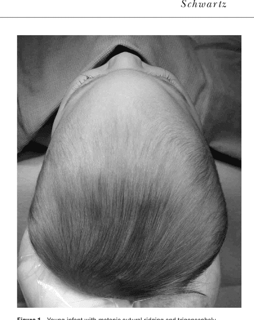 Congenital Metopic Craniosynostosis with Secondary Trigonocephaly: A ...