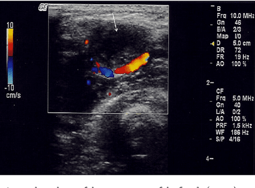 Figure 9 from Arteriovenous fistulas and grafts for haemodialysis: what ...