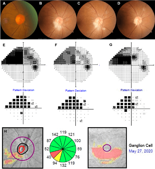 Figure 3 from Altitudinal Visual Field Defects Following Diagnostic ...