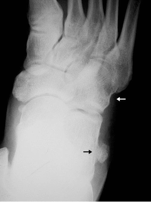 Figure 7 from Bilateral peroneus longus tendon rupture through a ...