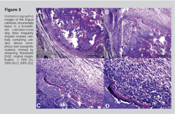 Figure 1 from Carbon Dioxide Laser Excision of Lingual Calcinosis ...