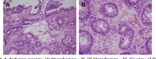 HISTOLOGIC AND CLINICAL FEATURES OF ACUTE VERSUS CHRONIC RADIATION ...