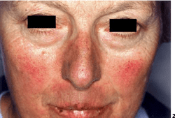 Cold Agglutinin Disease – The Importance of Cutaneous Signs | Semantic ...