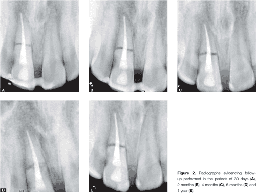 Figure 1 from Horizontal root fracture in the middle third: case report ...
