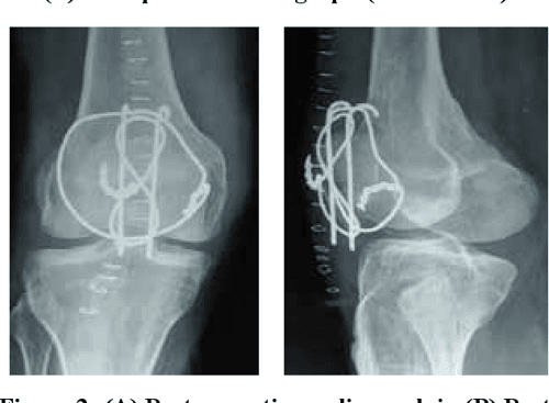 Figure 1 from Study between Fracture Fixation of Patella with Cerclage ...