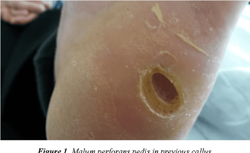 Figure 1 from Malum Perforans Pedis – Case Report | Semantic Scholar