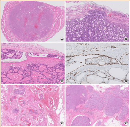 [PDF] Update from the 2022 World Health Organization Classification of ...