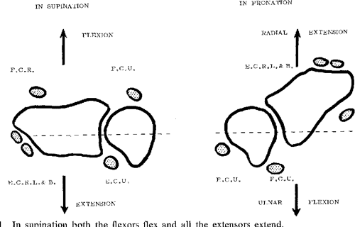 Figure 3 from The Zig-Zag Deformity in the Rheumatoid Hand | Semantic ...