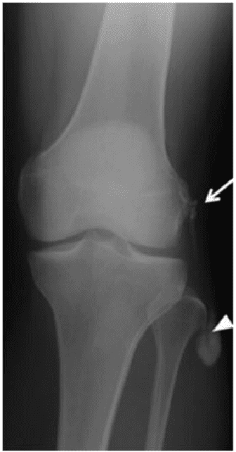 Symptomatic calcification of the lateral collateral ligament: a case ...