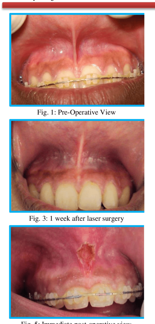 Figure 3 from MAXILLARY LABIAL FRENECTOMY USING DIODE LASER-REPORT OF ...