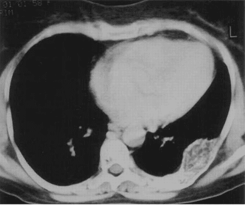 Intraosseous lipoma of the rib. | Semantic Scholar