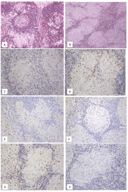 Figure 1 from Differences between CVID Granulomatosis and Sarcoidosis ...