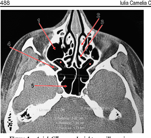 The maxillary recess of the sphenoid sinus. | Semantic Scholar