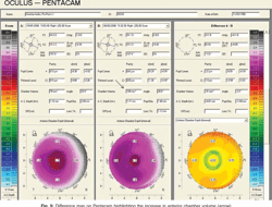 Figure 8 from Pentacam: Principle and Clinical Applications | Semantic ...
