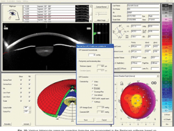 Figure 8 from Pentacam: Principle and Clinical Applications | Semantic ...