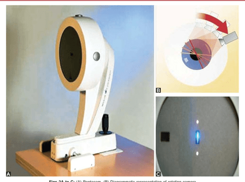 Figure 8 from Pentacam: Principle and Clinical Applications | Semantic ...