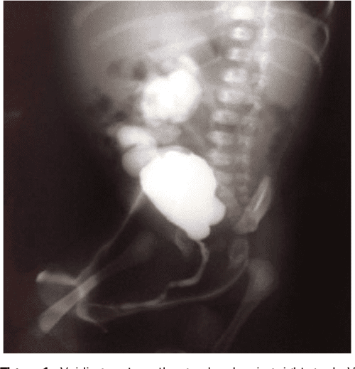 Figure 1 from Posterior urethral polyp with type I posterior urethral ...