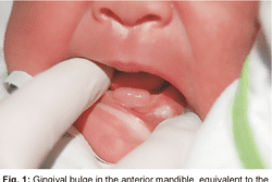 [PDF] Eruption Cyst in the Neonate | Semantic Scholar