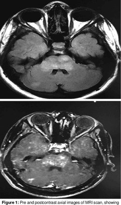 CHRONIC LYMPHOCYTIC INFLAMMATION WITH PONTINE PERIVASCULAR ENHANCEMENT ...