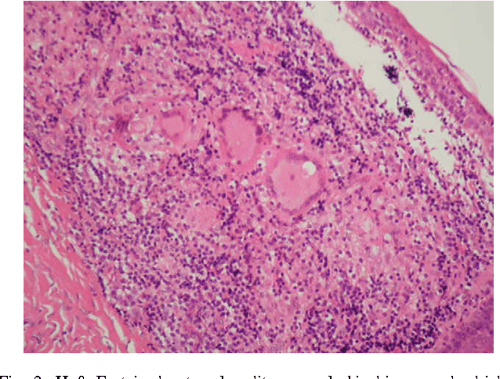 Figure 1 from Koebner phenomenon of the ear canal skin. | Semantic Scholar