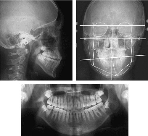 Figure 8 from Mandibular deviation and canted maxillary occlusal plane ...