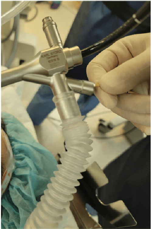 Figure 1 from Apnoeic oxygenation using transnasal humidified rapid ...