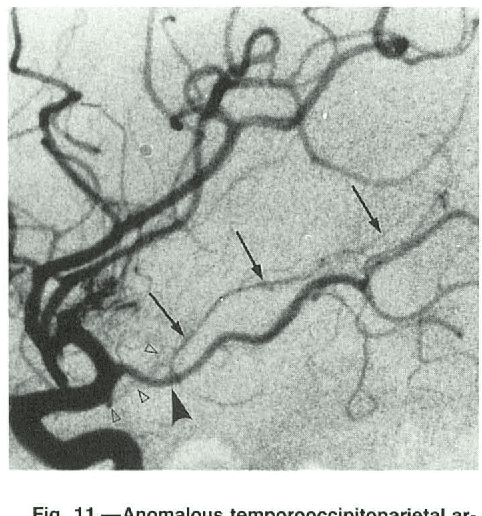 Figure 2 from Anterior choroidal artery: angiographic analysis of ...