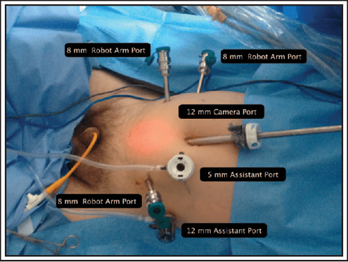 Figure 2 from Robot assisted radical prostatectomy: how I do it. Part I ...