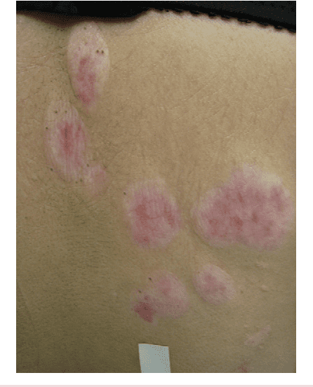 Figure 1 from Cutaneous manifestations of antiphospholipid antibody ...