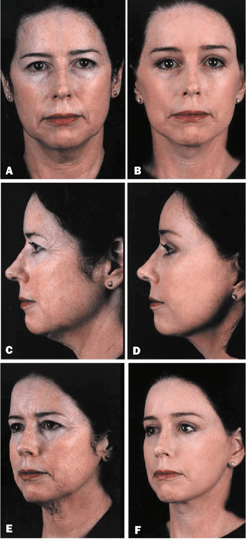 Figure 4 from The "high SMAS" face lift technique. | Semantic Scholar