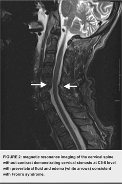 Figure 1 from Froin’s Syndrome Secondary to Traumatic and Infectious ...