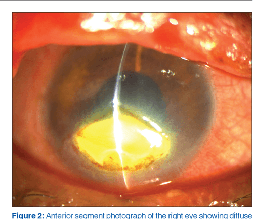 Herpes zoster ophthalmicus with ocular involvement in overtreated ...