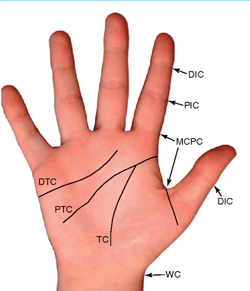 Figure 3 from Friction Ridge Skin : Morphogenesis and Overview Anatomy ...