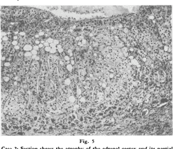 Simmonds' Disease | Semantic Scholar