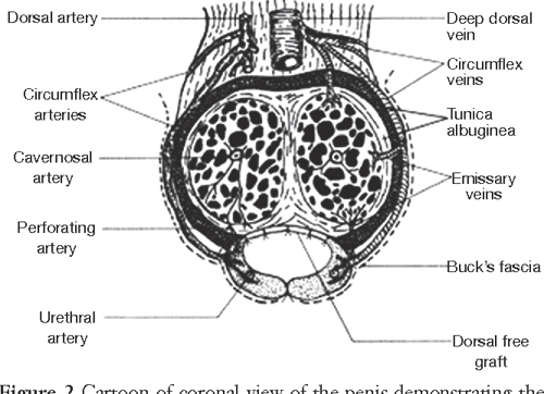 Figure 4 from Dorsal inlay buccal mucosal graft (Asopa) urethroplasty ...