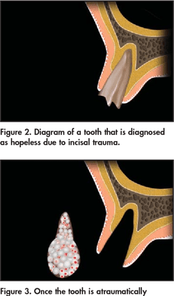 Figure 1 from A simplified socket classification and repair technique ...