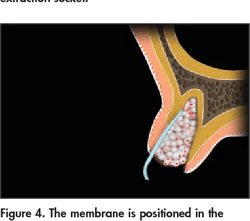 A simplified socket classification and repair technique. | Semantic Scholar