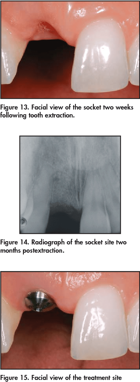 A simplified socket classification and repair technique. | Semantic Scholar